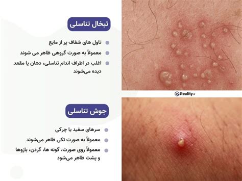 تفاوت جوش و تبخال تناسلی چیست؟ 5 تفاوت اصلی