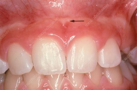 Maxillary Labial Frenectomy Stock Image C058 4576 Science Photo Library