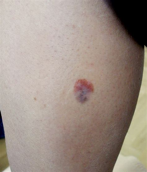 Melanoma On Leg Pictures 16 Photos And Images
