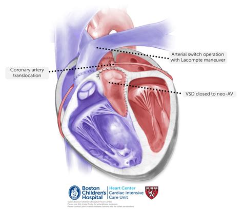 Subpulmonary Vsd Online Supplement