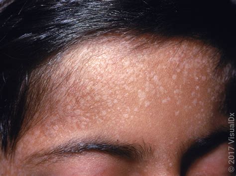 What Do Warts Look Like On Black Skin