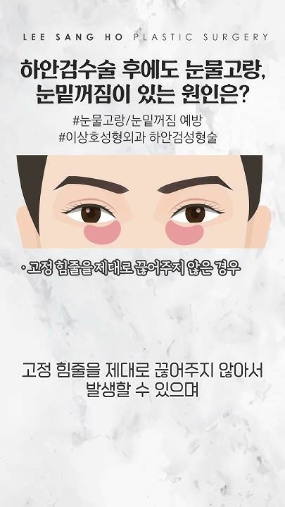 칙칙한 눈밑꺼짐 눈물고랑😱 하안검 수술 후에도 남아있다면💥 Youtube