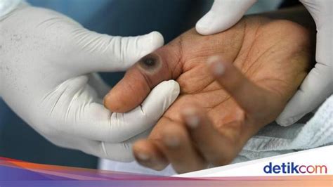 Gejala Cacar Monyet Mirip Infeksi Kulit Biasa Begini Membedakannya