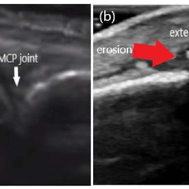 Conventional Radiograph Of The Right Hand And Second MCP Joint Of Our Download Scientific