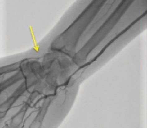 Managing Complications Of Transradial Catheterization Cardiac