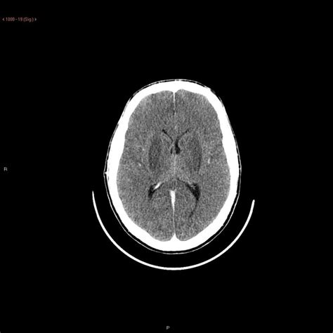 Methanol Intoxication Pacs