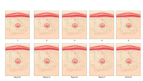 Understanding Your Circumcision Scar Healing