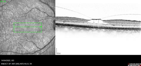 Vitreo Macular Traction Syndrome Vmts Dr Rehman Siddiqui