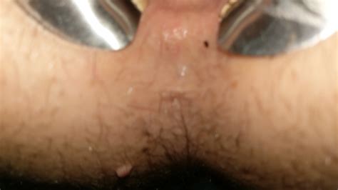 Speculum Worms Thisvid Com
