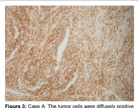 Figure 1 From Myopericytoma Of The Maxillofacial Region Semantic Scholar