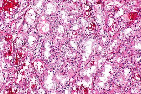 Renal Cell Carcinoma Grading Libre Pathology
