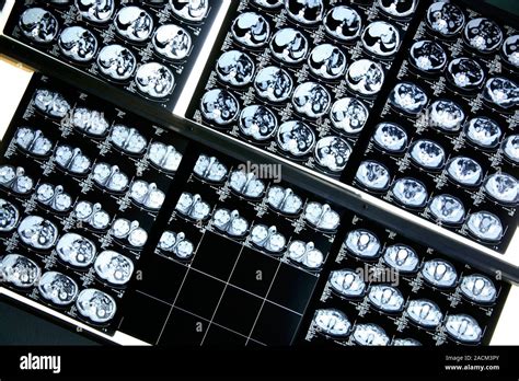 lungs computed tomography ct scans of the lungs of a patient with interstitial lung disease