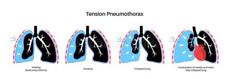 Tension Pneumothorax Poster Stock Vector Illustration Of Pneumothorax Breath 275008713