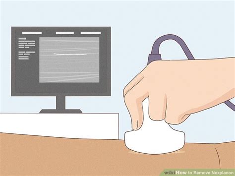 How To Remove Nexplanon Where To Get It Removed More