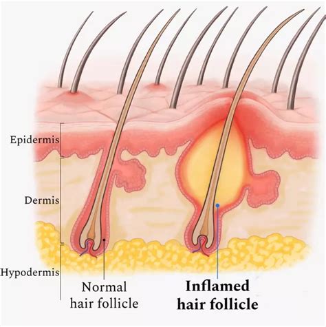Folliculitis What Is It Kirsten J The Hair Therapist