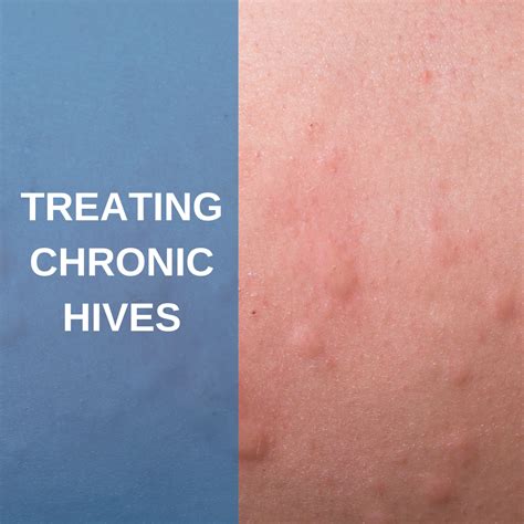 Urticaria Treatment Hives