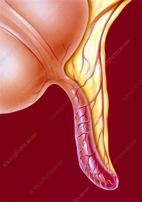 Illustration Of An Appendix With Appendicitis Stock Image M Science Photo Library