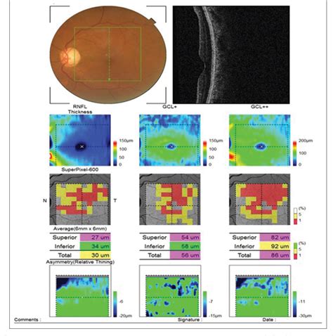 Figure 1 From Ganglion Cell Complex And Retinal Nerve Fiber Layer