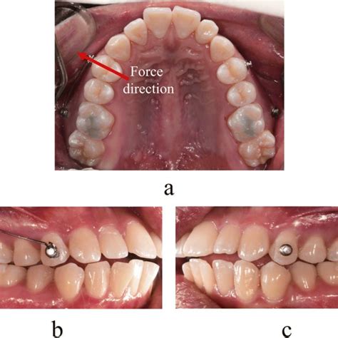 Schematic Diagram Of Tooth Movement Applying Orthodontic Force To The