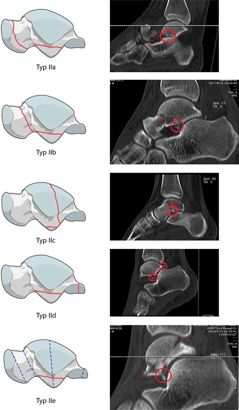New Classification Based On Ct And Its Value Evaluation For Fractures