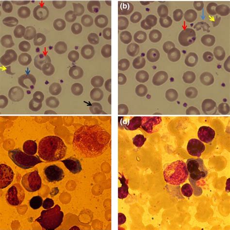 The Peripheral Blood Smear A B Liu Stain 1000× Showed Macrocytic
