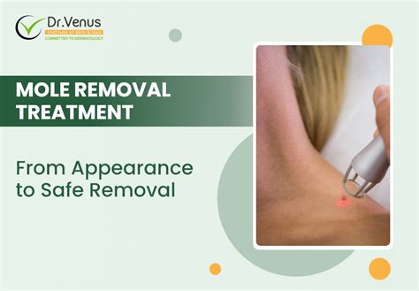 Mole Removal Treatment Appearance To Removal Dr Venus