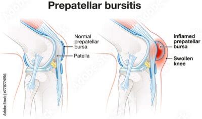 Prepatellar Bursitislabeled Medically Illustration Wall Mural • Murals