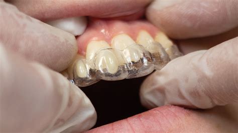 Alignerflow Lc Nano Hybrid Composite Voco Gmbh Alignerflow Lc Nano Hybrid Composite Voco Gmbh