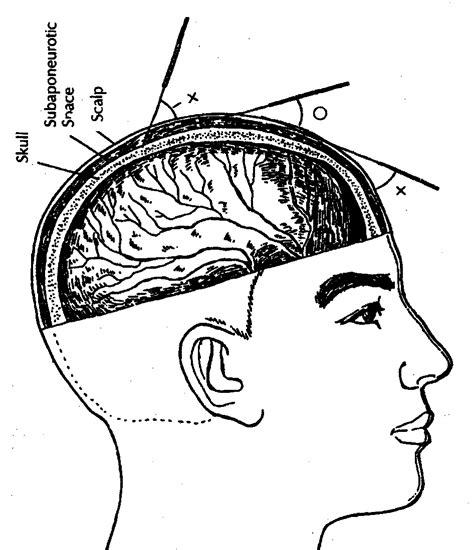 Treating Sci With Scalp Acupuncture