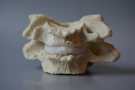 Anatomical Model Of Cervical Vertebrae Showing Degeneration Eanatomi