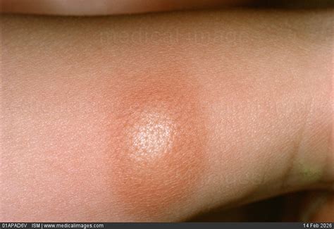 Stock Image Cutaneous Mastocytoma Mast Cell Tumor Of The Eyelid This