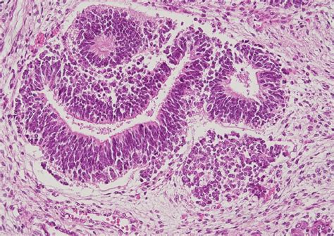 Immature Elements Of The Tumor Neuroectodermal Structures With Download Scientific Diagram