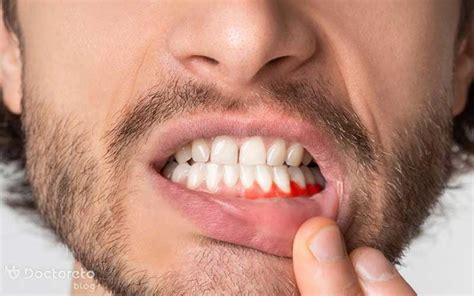 درمان عفونت دندان چگونه است؟ معرفی بهترین داروها و درمان عفونت در خانه