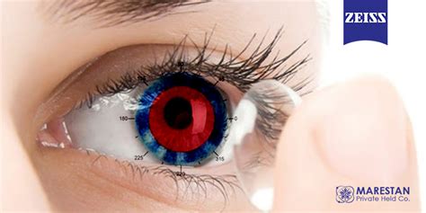 Calculation Of Toric Iol Power In Intraocular Lenses مارستان