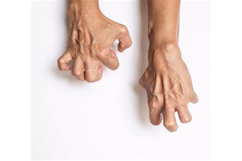 类风湿会引起颞颌关节炎吗39健康网风湿科