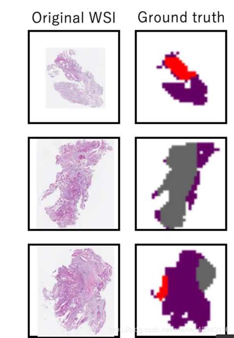 Multi Stage Pathological Image Classification Using Semantic