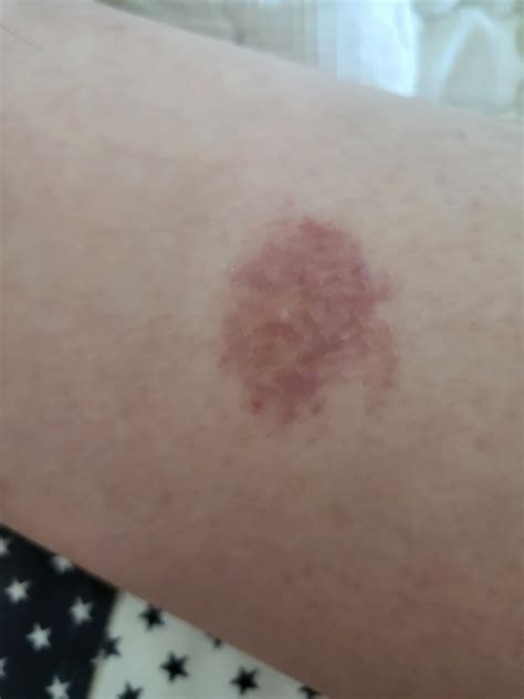 피부에 붉은 반점이 생겼습니다 이게 뭔가요 지식in