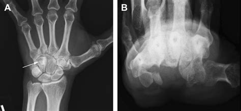 Fractures Of The Hamate And Pisiform Bones Hand Clinics