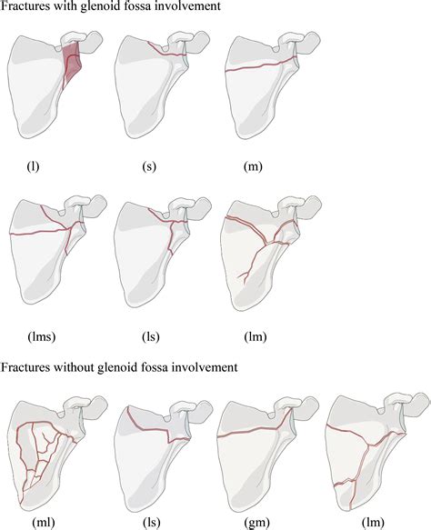 Scapula Fracture Classification At Reynaldo Leahy Blog