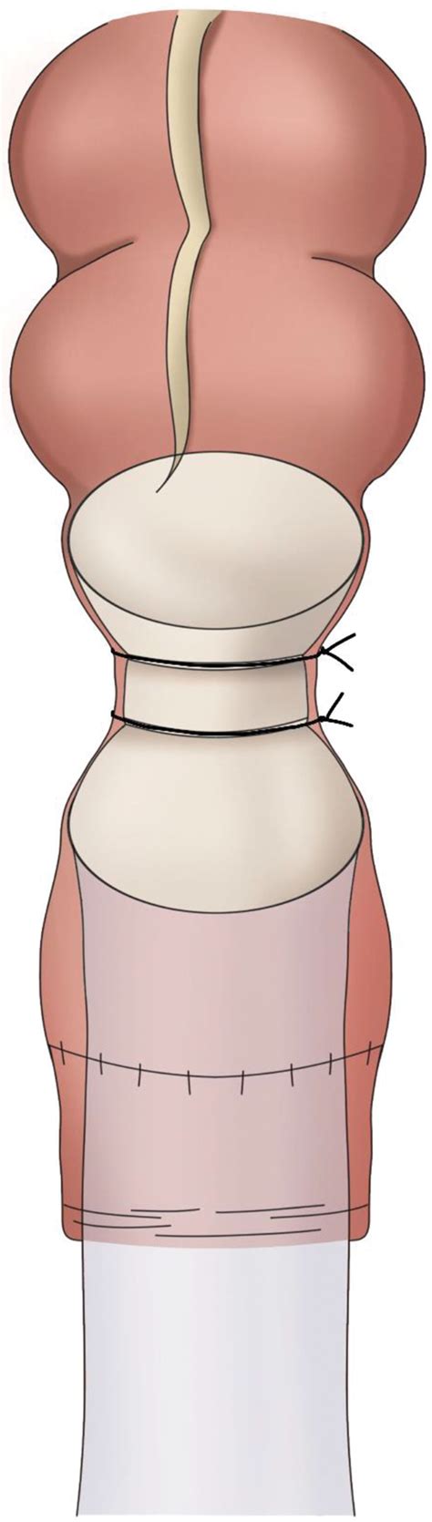 Clinical Application Of A Novel Stent Assisted In Situ Intestinal Bypass In Preventing