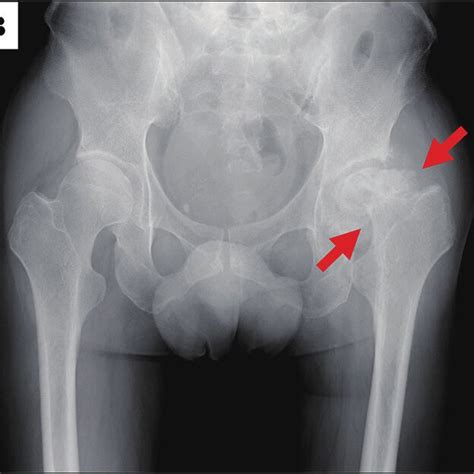 Pelvic X Ray Transition A Pelvic X Ray At The Admission To Out Download Scientific Diagram