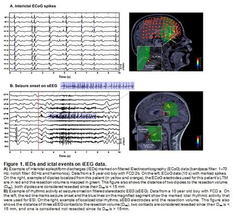 clinical utility of electric source imaging on intracranial