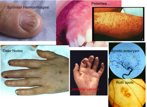 Infective Endocarditis Ie Flashcards Quizlet