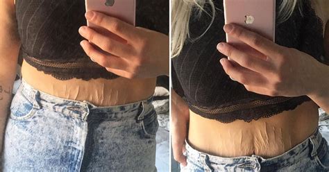 Blogger Body Positive Stretch Marks Photos Message