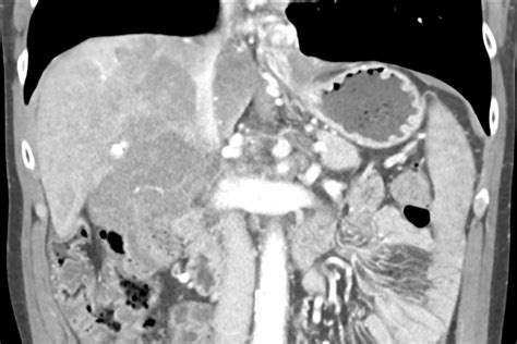 What Is A Shock Liver At Jessica Stock Blog