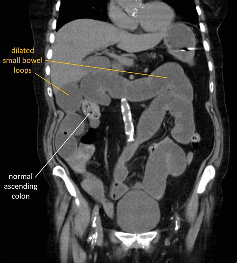 Sigmoid Volvulus Mri