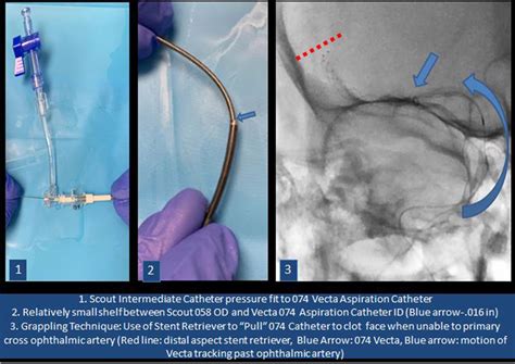 E 120 Vecta 071 And 074 Large Bore Aspiration Catheter Initial Multi