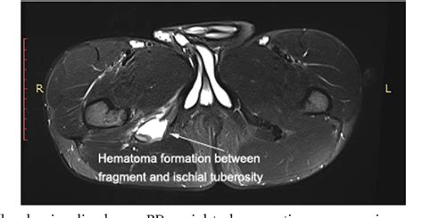 Figure 3 From Treatment Of Acute Bony Avulsion Of Ischial Tuberosity With Cortical Screw