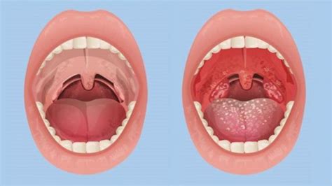 Treatment Of Pharyngitis Клиника доктора Максудовой