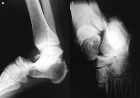 Isolated Acute Traumatic Subtalar Dislocations Review Of 13 Cases At A
